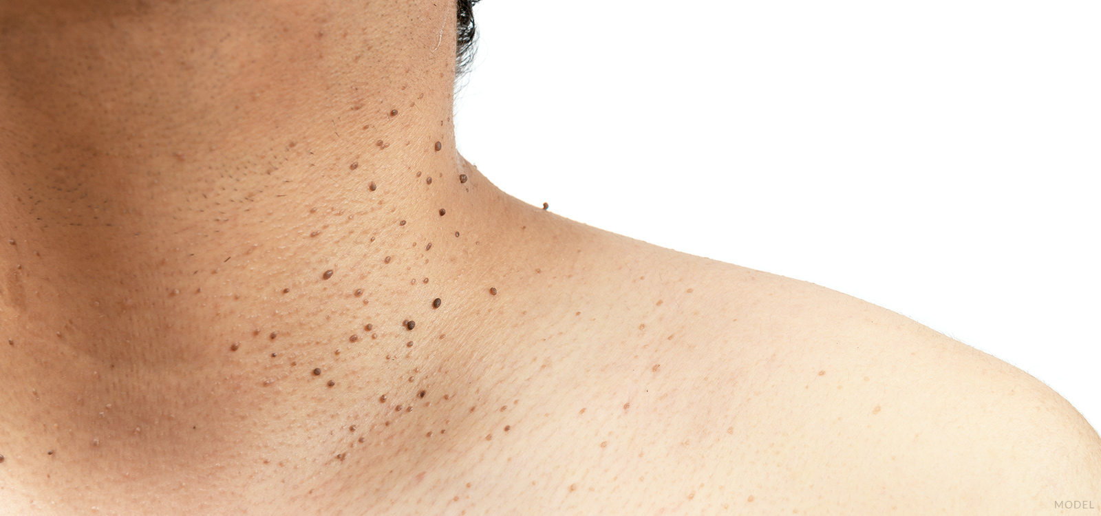 What You Need To Know About Skin Growths - Boise Dermatology & Medspa